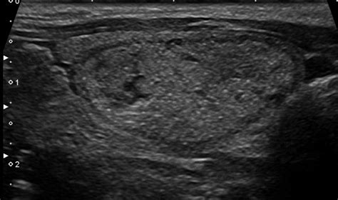 Thyroid Ultrasound Reporting Lexicon White Paper Of The Acr Thyroid