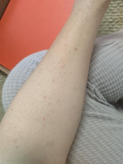 Rash On Forearm Rdermatologyquestions