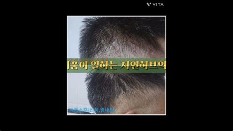 샴푸클리닉소자본창업두피탈모전문점두피디톡두피탈모천연염색엑손알앤디이즈에디슨엑손디톡short탈모 Youtube