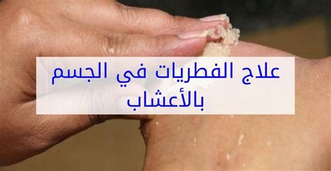 علاج الفطريات وارشادات للوقاية من فطريات الجلد