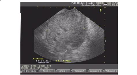 Endoscopic Ultrasound Showing A Homogeneous Hypoechoic Mass With Areas