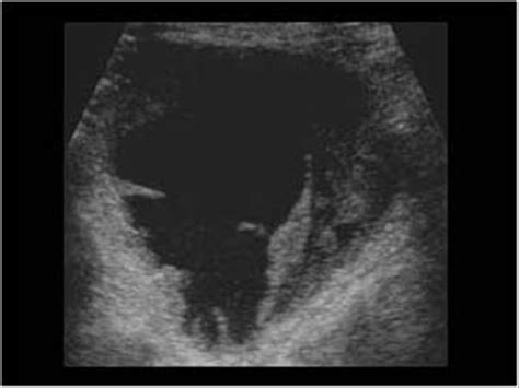 Gynaecology 31 Uterus Case 313 Malignant Uterine And Cervical
