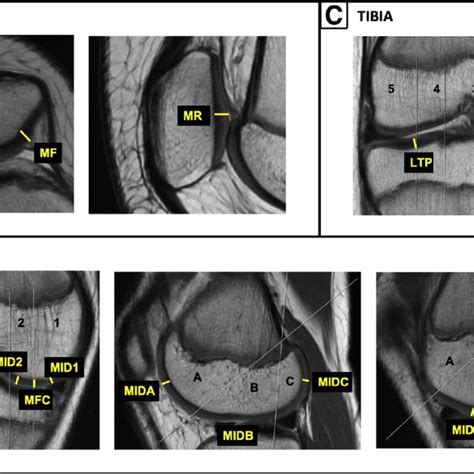 Mri Measurements Of Articular Cartilage Thickness Articular Cartilage