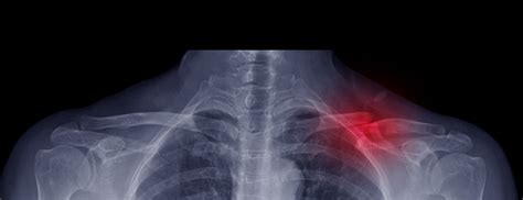 Clavicle Fracture Collar Bone Specialist Sugar Land P