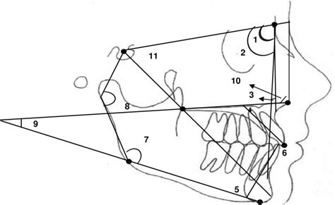 Angular Cephalometric Measurements 1 Sna 2 Snb 3 Anb 4 1 Pal 5
