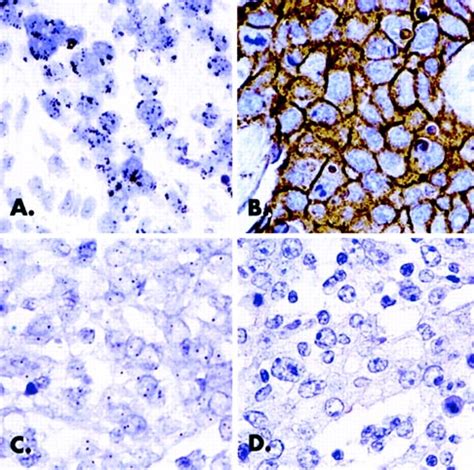 HER2 CISH And IHC Staining In Breast Carcinomas CISH Of HER2 Gene