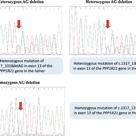 Sequencing Chromatogram Of Genomic Dna Showing C 1317 1318delag Download Scientific Diagram