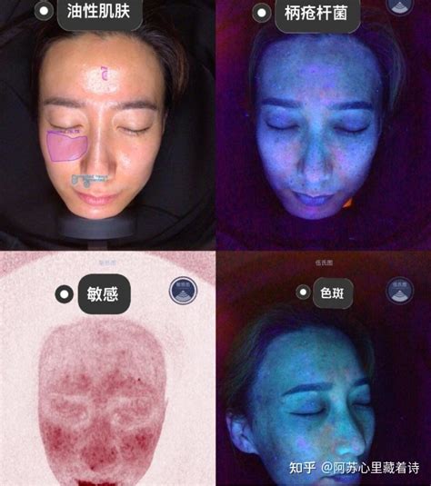 从医学角度来看，鼻子上的黑头越去越多，到底应该怎么办？ 知乎