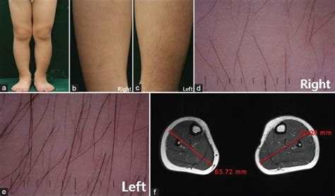 A Case Of Idiopathic Hemihypertrophy With Hemihypertrichosis Pmc
