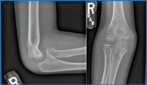 Panners Disease A Case Report