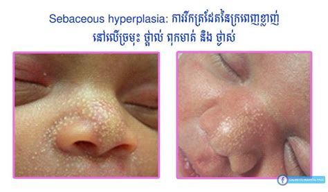 វិធីព្យាបាលប្រភេទជំងឺសើសែ្បកមួយចំនួន ដែលកើតលើកេ្មងតូចៗ សារព័ត៌មាន នគរវត្ត