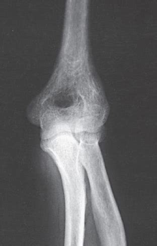 Procedures Forearm Elbow Humerus Test Flashcards Quizlet