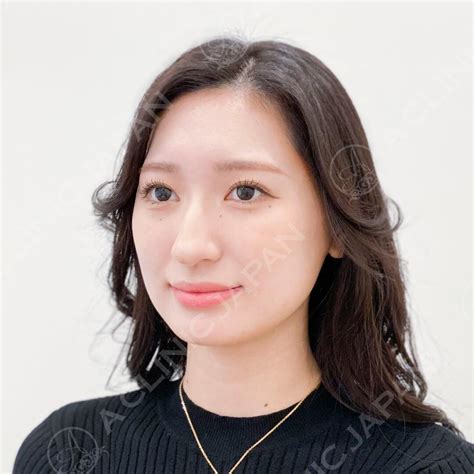 1day小顔脂肪吸引なら固定バンドが一切必要ございません！処置前と処置直後の症例です20代女性 A Clinicは小顔・リフトアップ