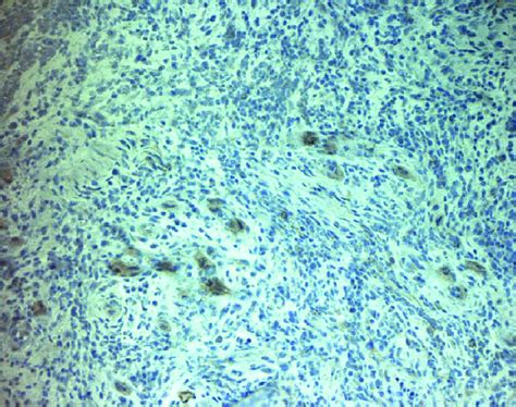 Immunohistochemical With Monoclonal Antibody Versus Mmp9 With
