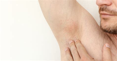 Common Habits That Can Cause Armpit Pimples And What To Do About Them The Hearty Soul