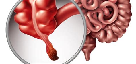 أعراض الزائدة الدودية عند النساء موضوع