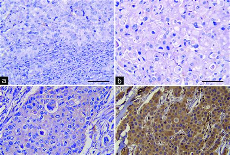 Mt1 Mmp Expression In The Cytoplasm Of Ibc Nst Tumor Cells As Shown By