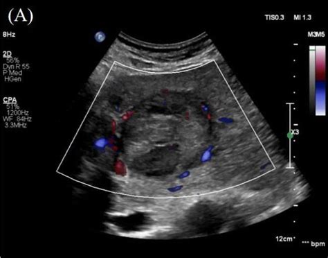 A Representative Example Of Microvascular Flow Imaging Examination In A