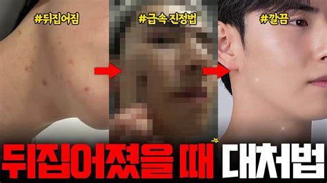 가장 효과 봤던 뒤집어진 피부 되돌리는 방법🔥🔥 Youtube