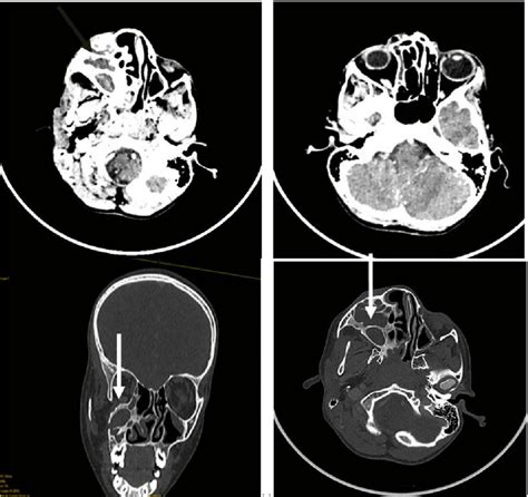 The Axial Ct Showed A Large Mass Involving The Right Ethmoid Cells And