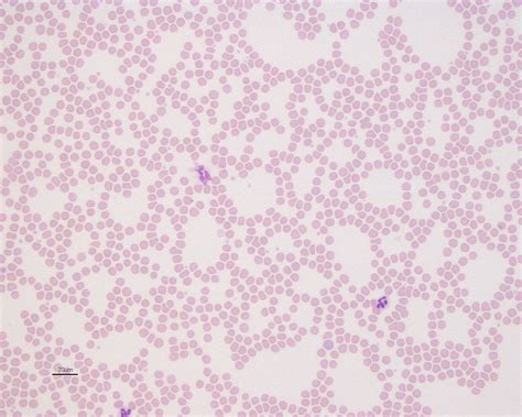 Blood Smear Features Eclinpath
