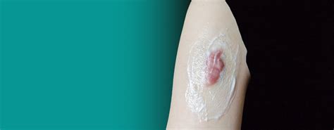 Collagen And Scar Tissue How It Forms Heals And What Treatments Work