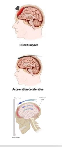 Neurology Pathophysiology Flashcards Quizlet