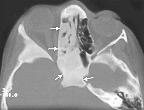 Axial Ct Scan In A Patient With Fibrous Dysplasia Shows Expansile