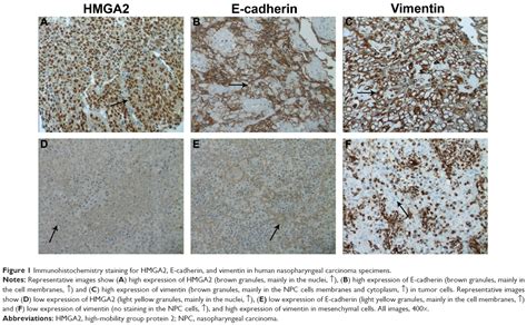 Hmga2 Is Associated With Epithelialmesenchymal Transition And C Ott