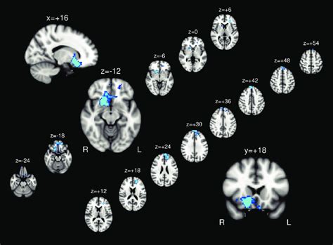 Anterior Piriform Connectivity Regions That Showed Significantly