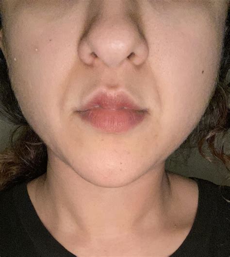 Nasolabial Folds Not Going Away After 2 Ml Cheek Filler In Total R
