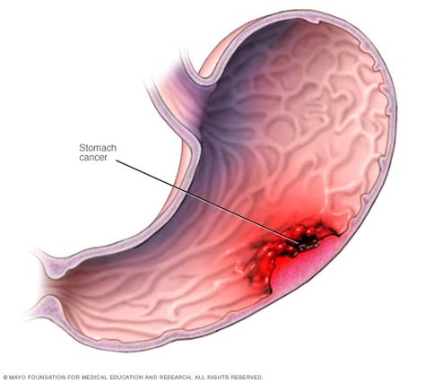 Gastric Cancer Types