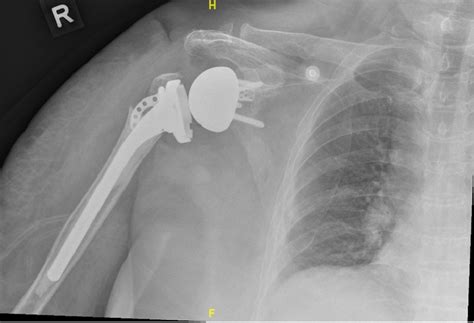Postoperative Image Showing The Re Attachment Of The Greater Tuberosity