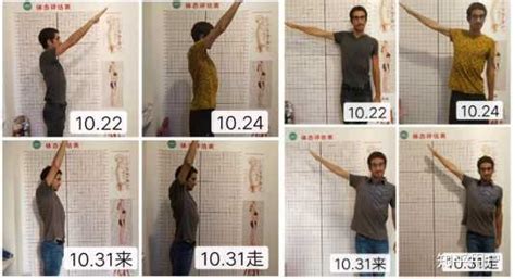 肩部脱位手术后如何康复？ 知乎