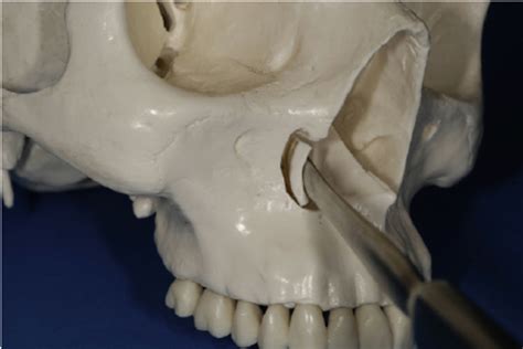 Clinically Note That The Osteotomy Of The Nasal Wall Is Feasible