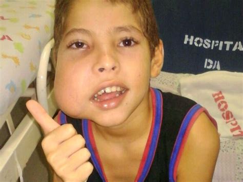 G1 Tumor deforma rosto de menino de 11 anos no AC e tio pede ajuda notícias em Acre