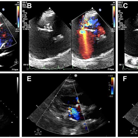 Figure E Pre And Postoperative Tte Images A Pre Tte Parasternal