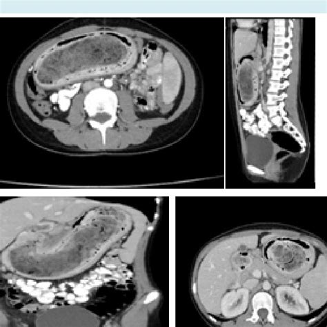Abdominal And Pelvic CT Scan Download Scientific Diagram