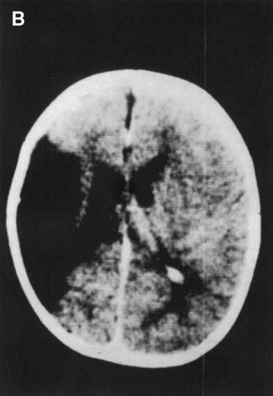 a eeg segment for a 43 week two day old infant with preserved eeg