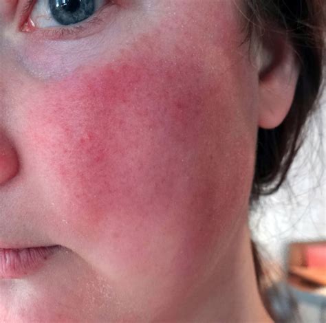 Puffy Cheeks Causes Symptoms How To Get Rid Of Cheek Puffiness