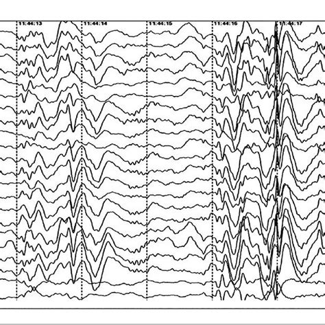 Electroencephalogram Showing Generalized Spike Wave And Multispike Wave