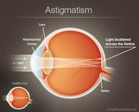 How To Treat Cylinder Number Astigmatism In Eyes