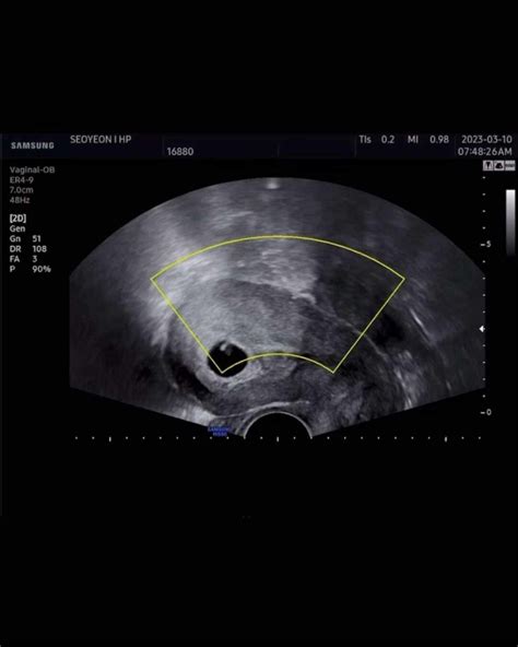 직장인 시험관 동결이식 1차 5일배양 25일차6주1일 29일차6주5일초음파심장소리출혈절박유산 네이버 블로그