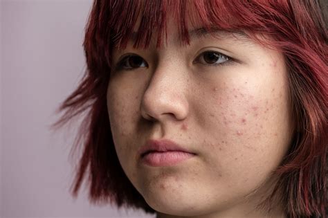 Whiteheads Causes Treatment And Prevention Remotederm