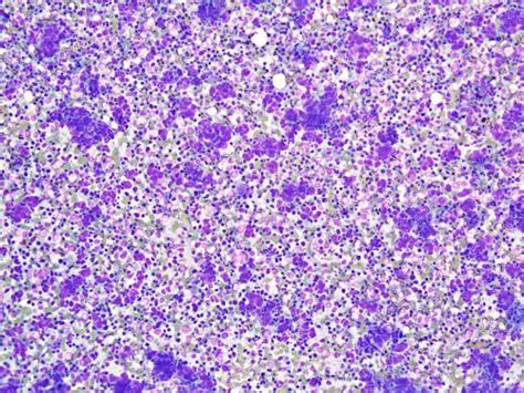 Lymph Node Fna Saudi Society Of Cytotechnology And Histotechnology