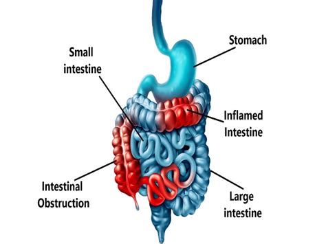 Chronic Intestinal Pseudo Obstruction Cip Treatment In India Heed Health
