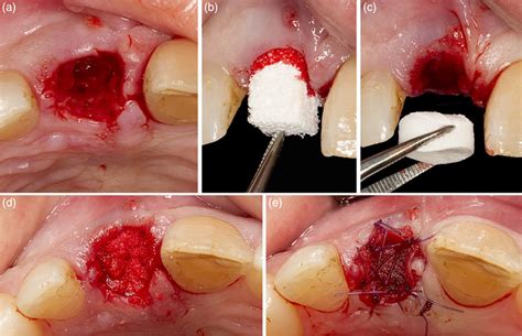 A Depending On The Size Of The Extraction Socket About 610 Small