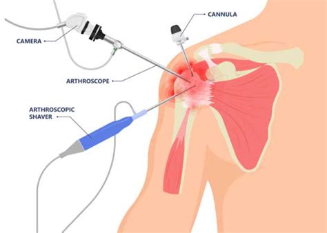 Shoulder Arthroscopy Shoulder Pain Orthopedic Shoulder Surgeon