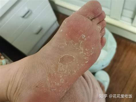 狼毒治疗脚气测试实时更新 知乎