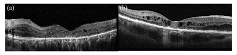 Atrophic Diabetic Maculopathy A Central Retinal Thinning With